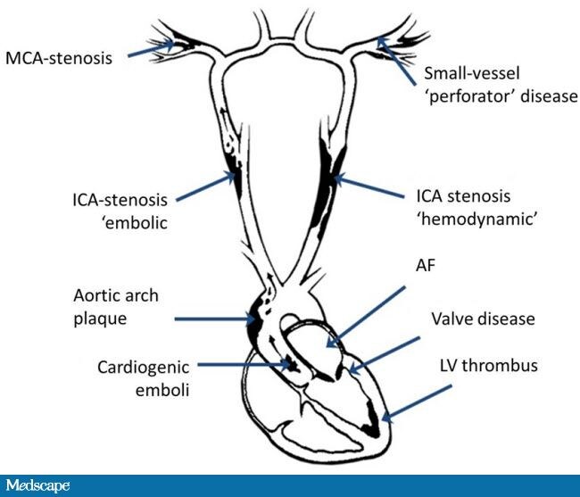 Cryptogenic Stroke: What, When, and How to Treat for Secondary Prevention