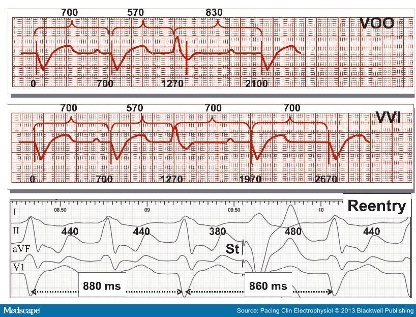 Resetting and Entrainment of Reentrant Arrhythmias: Part I - Page 2