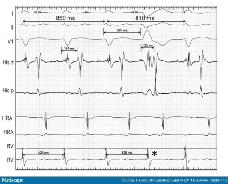 Resetting and Entrainment of Reentrant Arrhythmias: Part I - Page 7
