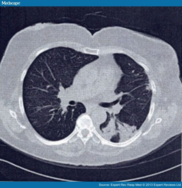 Post-Breast Cancer Radiotherapy BOOP - Page 4