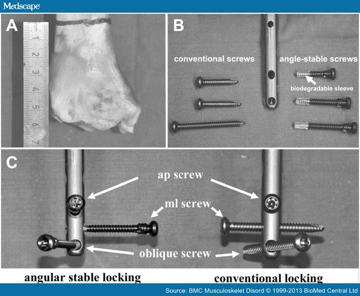 Angle-Stable Intramedullary Nails in Distal Tibia Fractures - Page 3