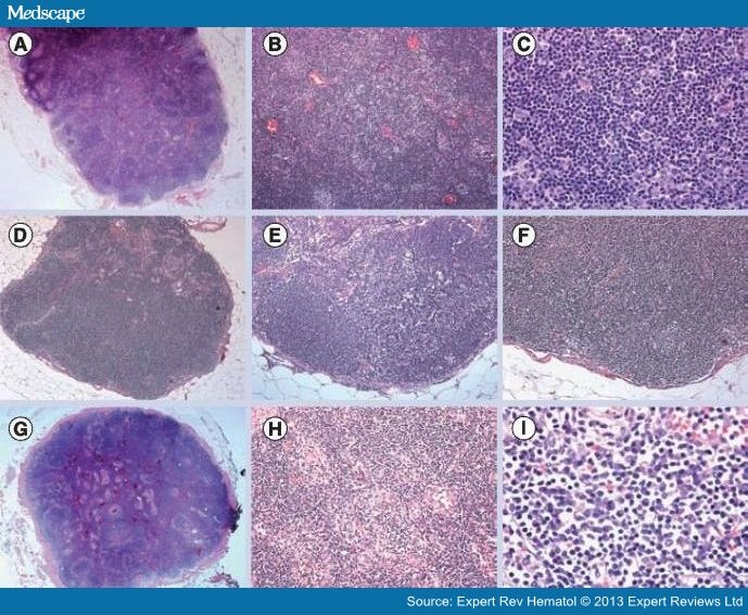 Atypical Lymphoid Proliferations - Page 4