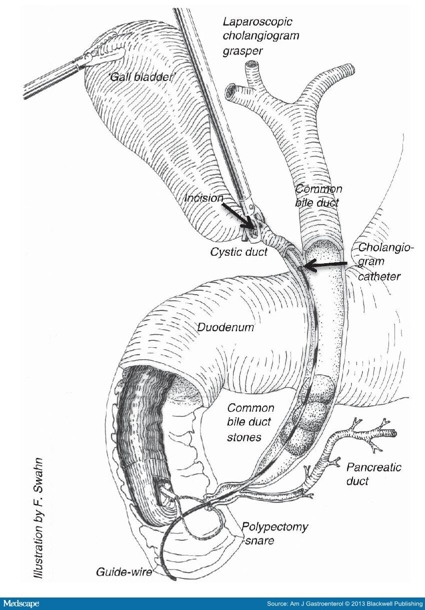 Post-ERCP Pancreatitis: Rendezvous Cannulation Technique