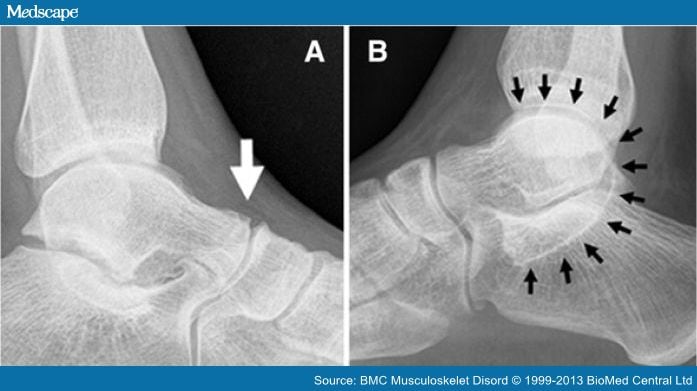 Fracture of a Talocalcaneal Coalition After an Ankle Sprain - Page 4
