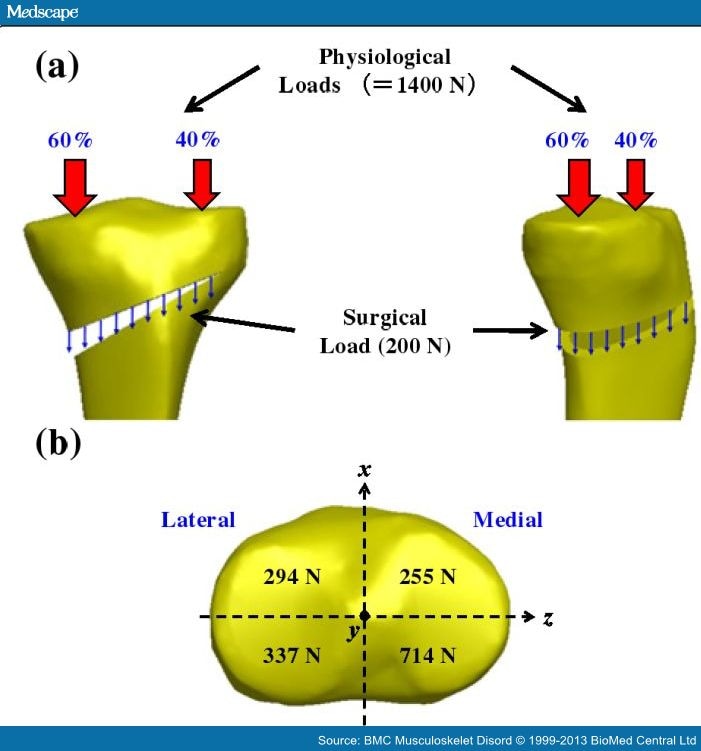 Comparing Different Systems for High Tibial Osteotomies - Page 3