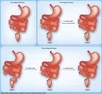 The Surgical Treatment of Inflammatory Bowel Disease-Associated Dysplasia