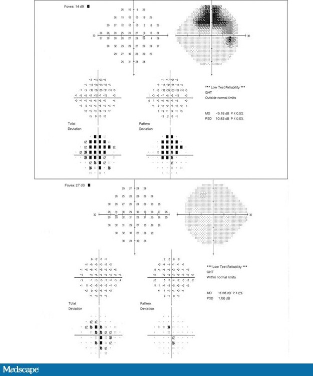 A 29-Year-Old Man With Progressively Decreased Vision