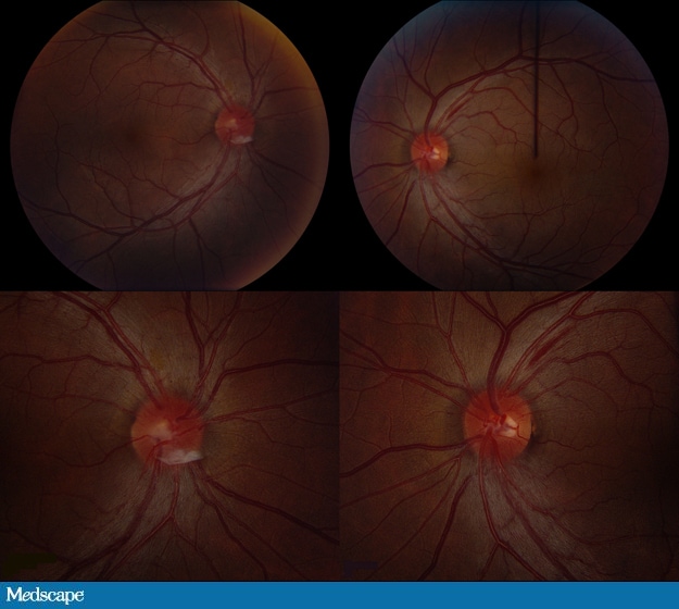 A 29-Year-Old Man With Progressively Decreased Vision