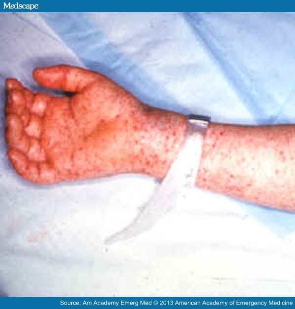 Deadly Rashes Not to Miss in the ED