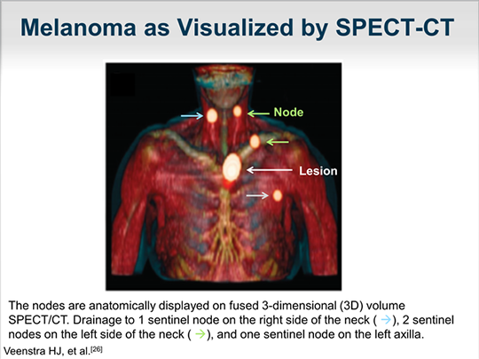The Importance Of Accurate Lymph Node Mapping Breast Cancer Or