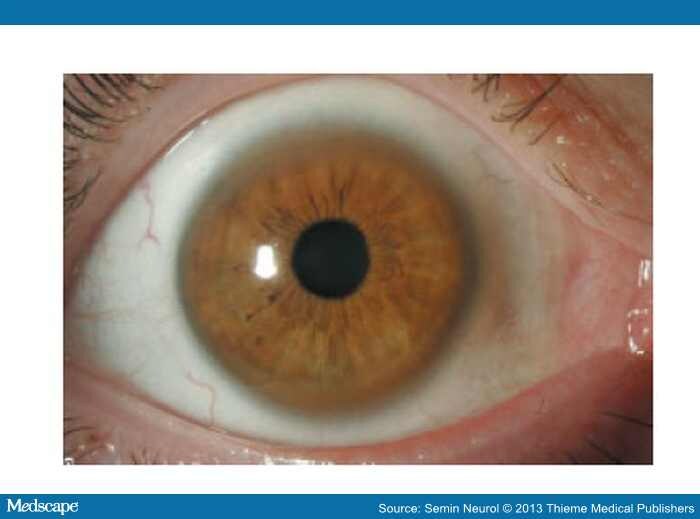 Recognition and Treatment of Neurologic Wilson's Disease