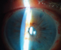 Late in-the-Bag Intraocular Lens Dislocation Requiring Explantation ...
