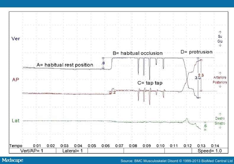 Comparison of Sensory and Motor TENS in Patients with TMD - Page 3