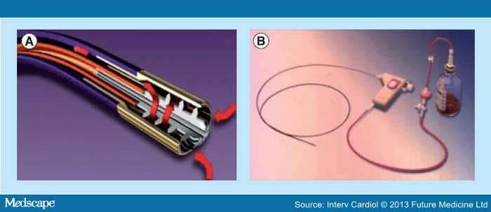 Primary Percutaneous Coronary Intervention - Page 3