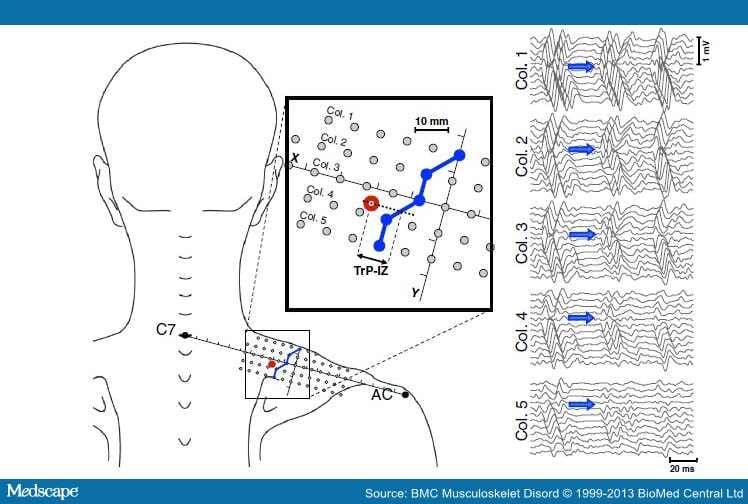 MTrPs, Innervation Zone Locations in Trapezius Muscles - Page 3