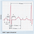ECG Abnormalities and Stroke Incidence