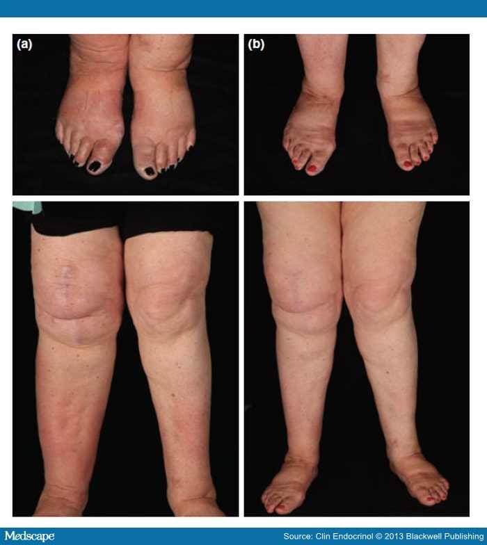 Graves Dermopathy Pictures Feet Pretibial Myxedema