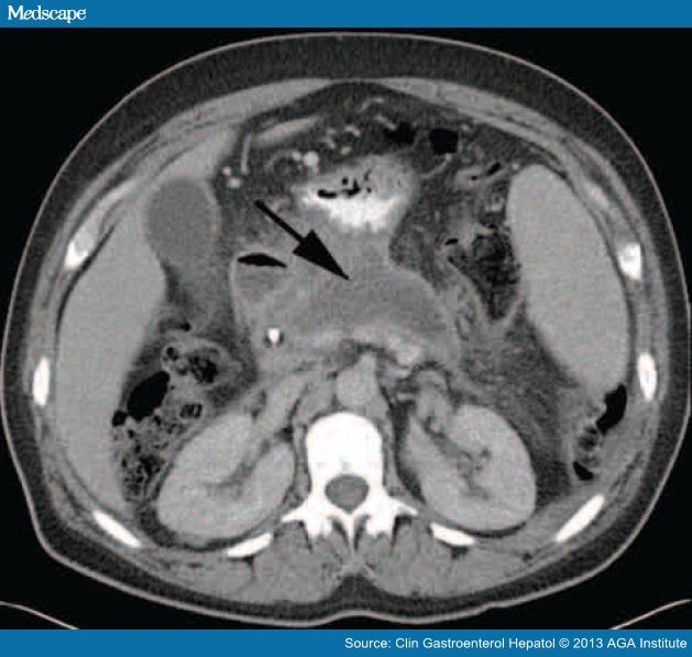 Interventions for Necrotizing Pancreatitis - Page 3