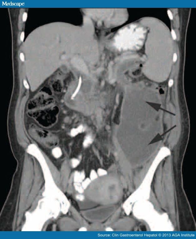 Interventions for Necrotizing Pancreatitis - Page 3