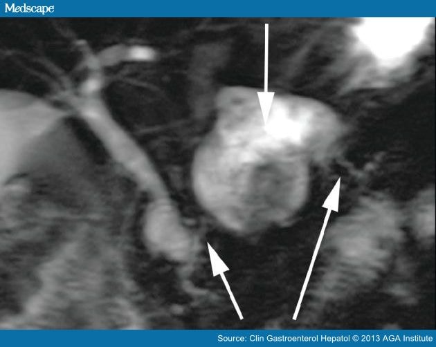 Interventions for Necrotizing Pancreatitis - Page 3