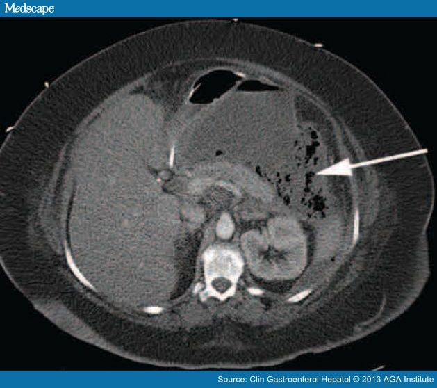 Interventions for Necrotizing Pancreatitis - Page 3