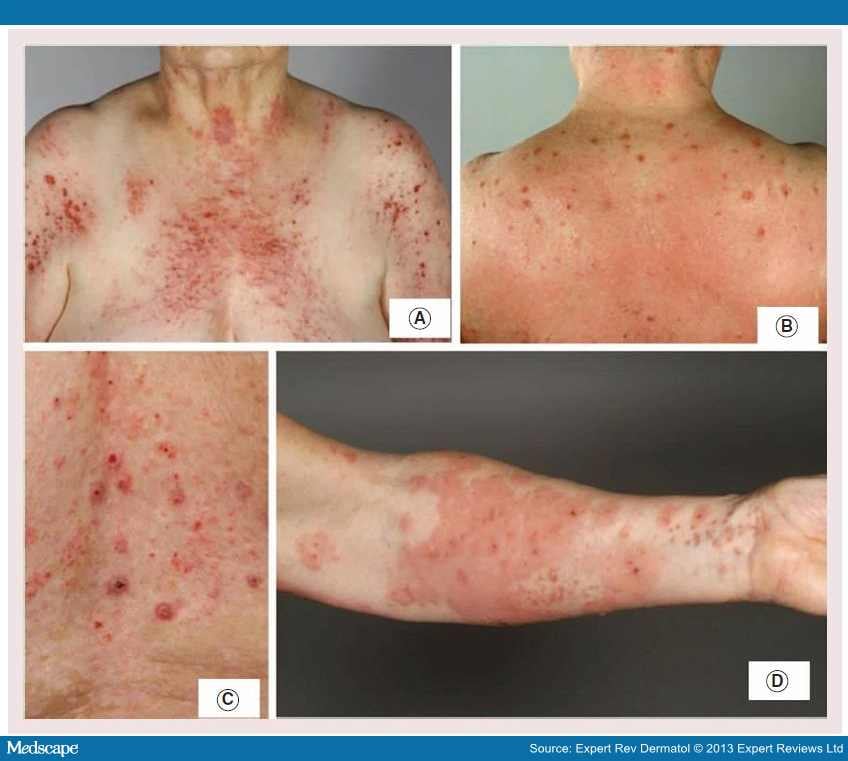 Nonbullous Pemphigoid