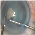 Microincision Cataract Surgery - Page 4