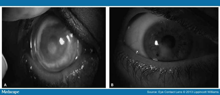 Amniotic Membrane ProKera for Ocular Surface Disorders - Page 3