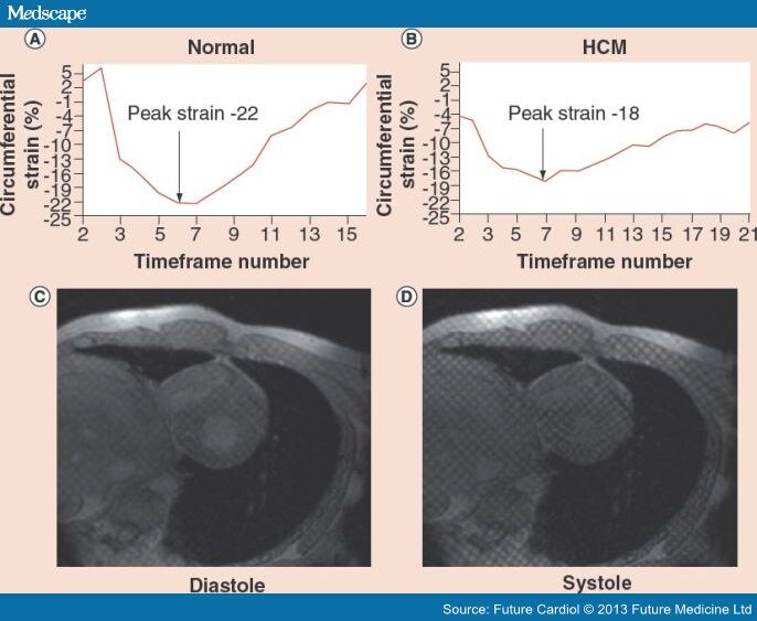 Advances of Cardiovascular MRI in Hypertrophic Cardiomyopathy - Page 4