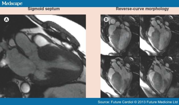 Advances of Cardiovascular MRI in Hypertrophic Cardiomyopathy - Page 4