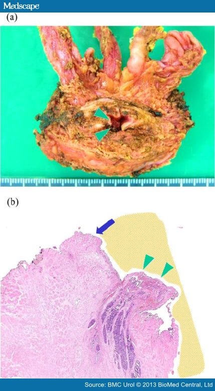 Transurethral Marking Incision of the Bladder Neck - Page 3
