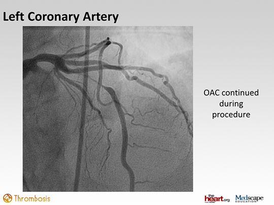Clinical Crossroads in Thrombosis: Stroke Prevention in AF; Secondary ...