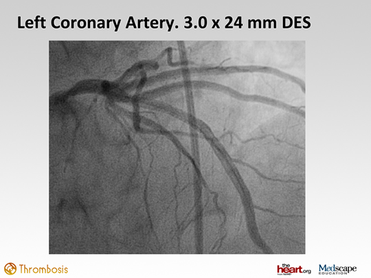 Clinical Crossroads in Thrombosis: Stroke Prevention in AF; Secondary ...