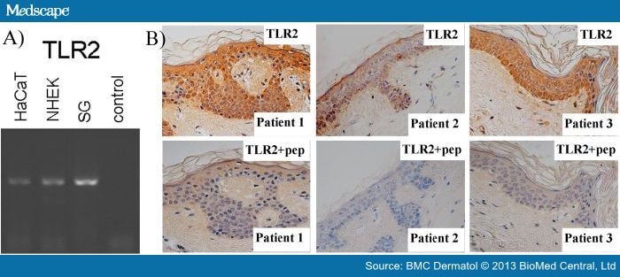 Toll-like Receptor 2 Activation and Comedogenesis in Acne - Page 4