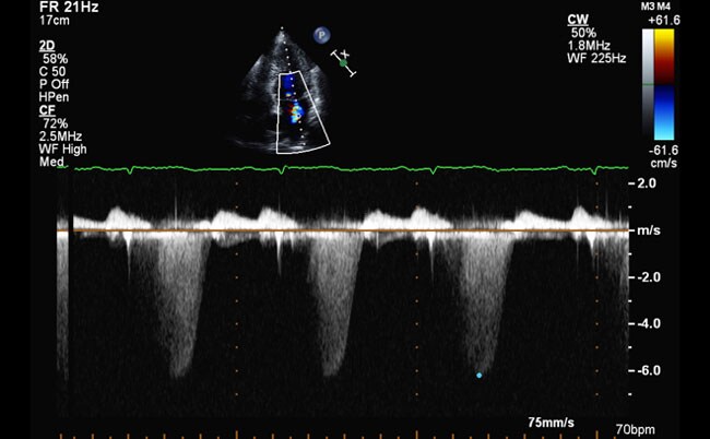 CW-Doppler through the mitral valve of a 40-year-old woman