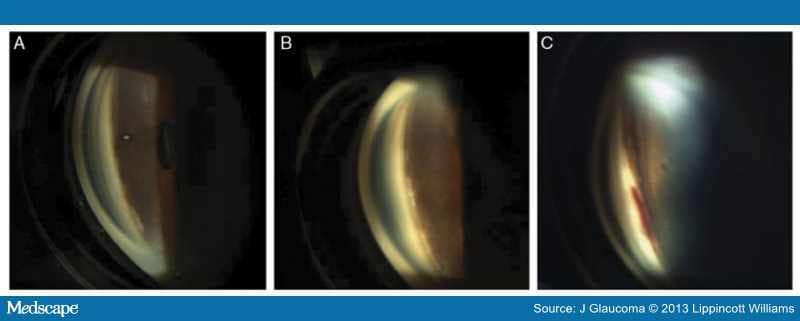 Goniopuncture to Treat Post-Trabectome IOP Elevation - Page 3