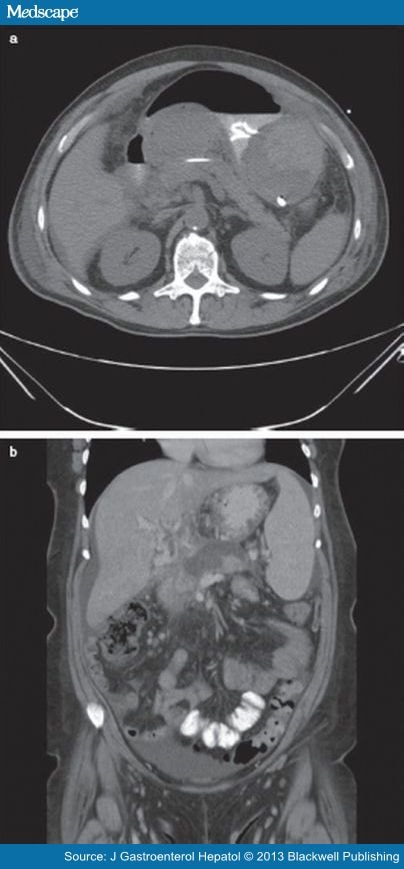 Endoscopic Management of Walled-off Pancreatic Necrosis - Page 4