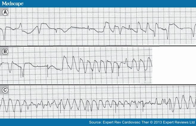 Torsades de Pointes Following Clarithromycin Treatment - Page 2