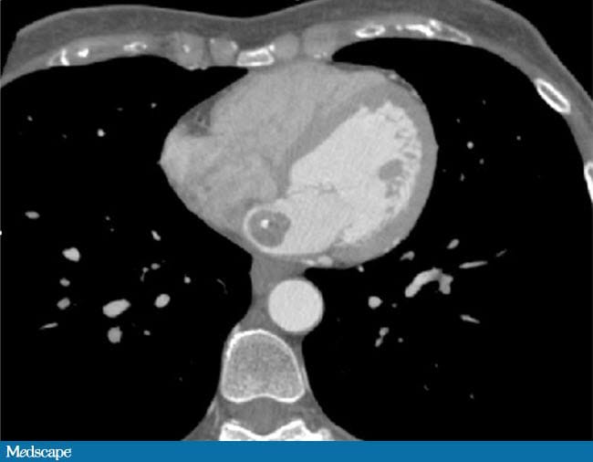 CT coronary angiography to assess for CAD: what does this image show?