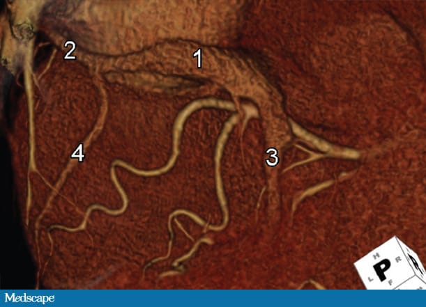 Correct interpretation of coronary artery images: identify the numbered ...