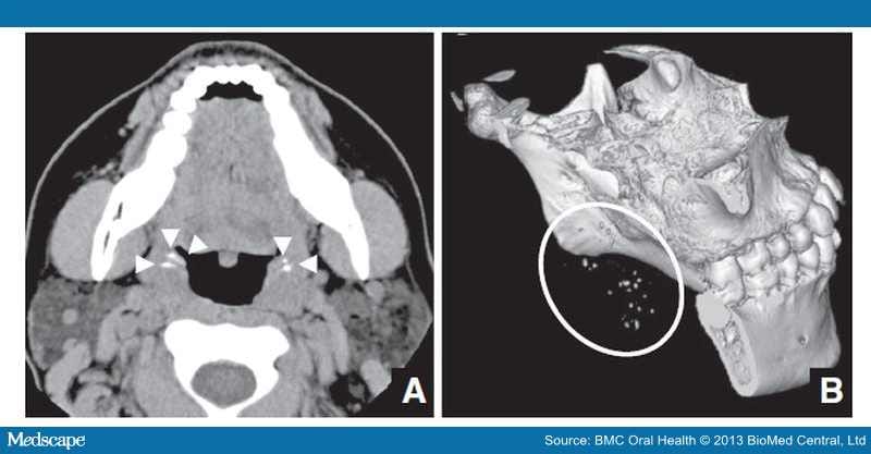 Tonsilloliths on CT and Panoramic Radiographs