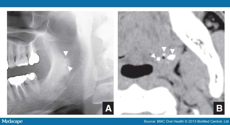 Tonsilloliths on CT and Panoramic Radiographs - Page 4
