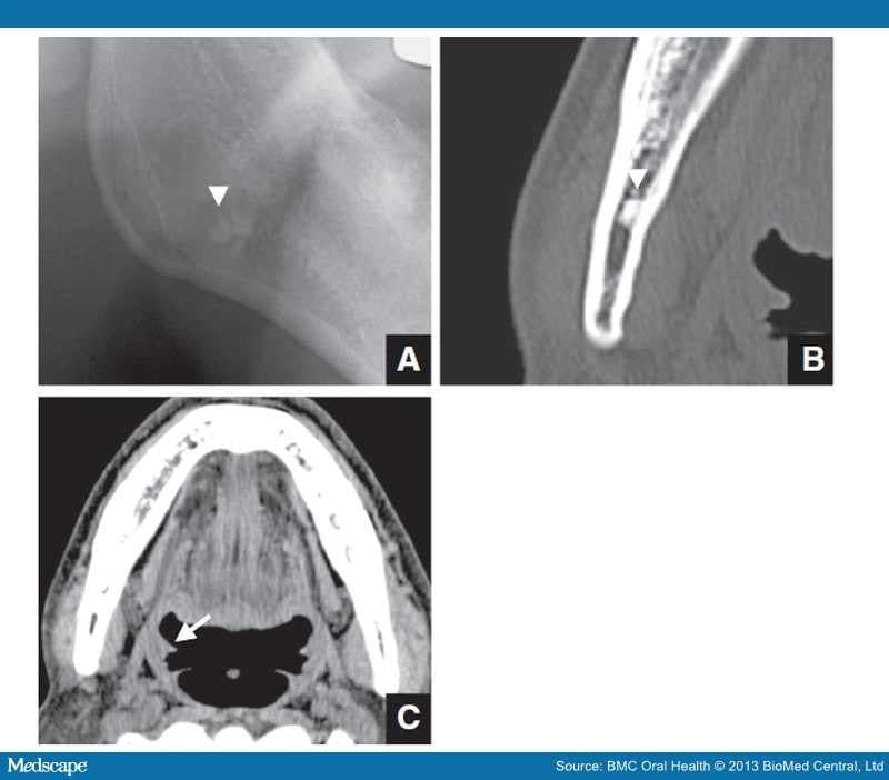 Tonsilloliths on CT and Panoramic Radiographs - Page 4