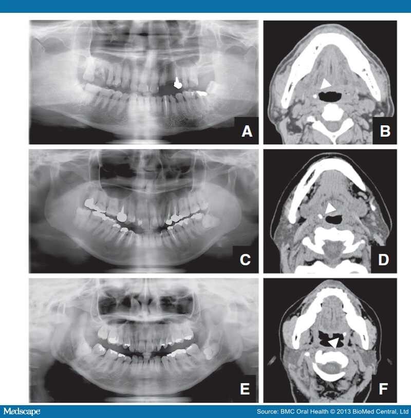 Tonsilloliths on CT and Panoramic Radiographs - Page 4