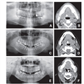 Tonsilloliths on CT and Panoramic Radiographs - Page 4