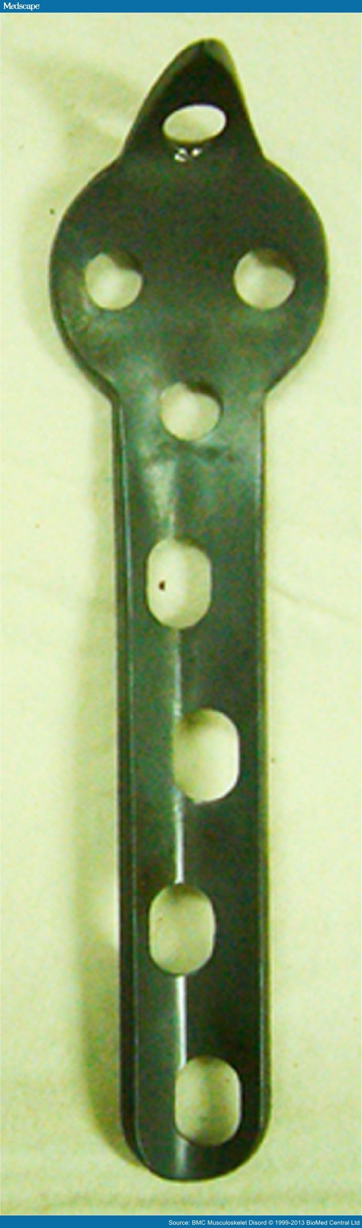 Central Tension Plate With Sharp Hook for Olecranon Fracture - Page 3