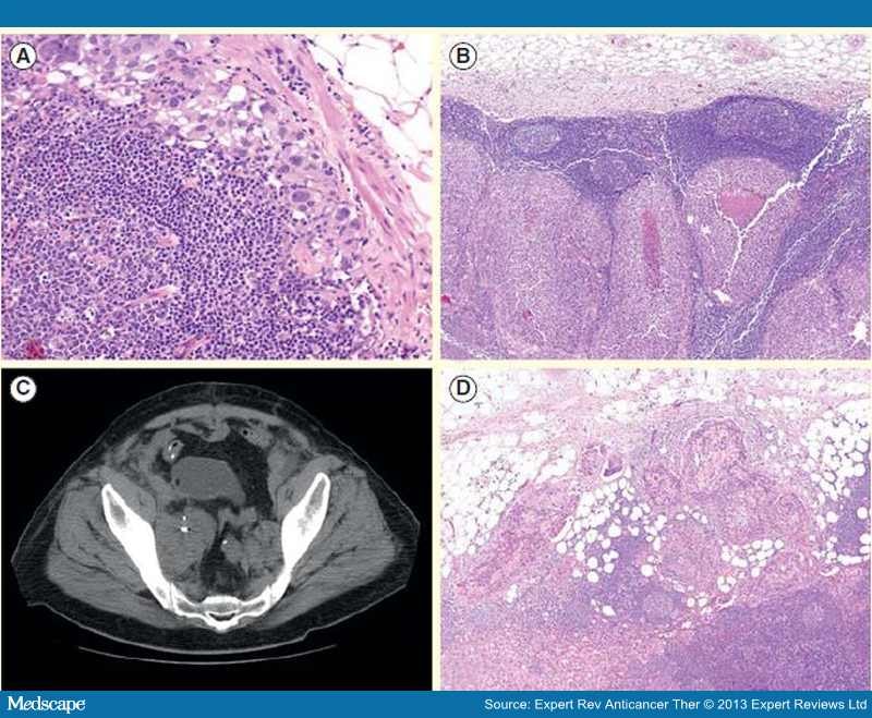 Lymph Node-Positive Bladder Cancer - Page 6
