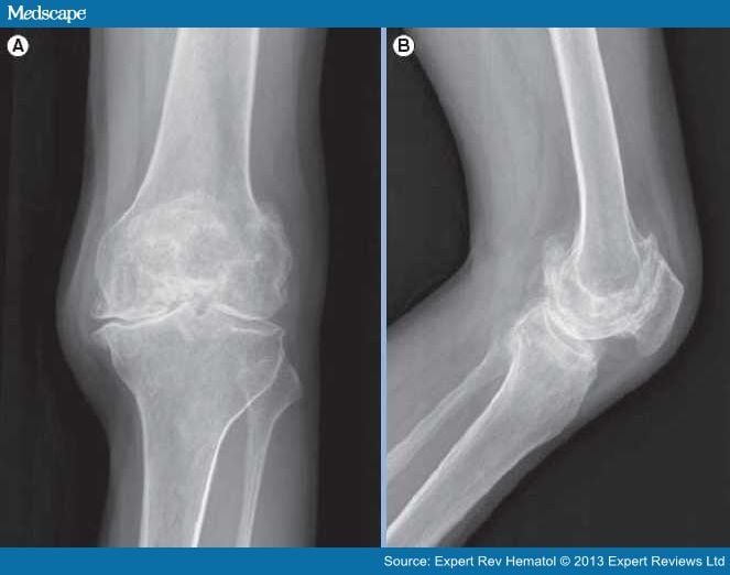 Special Features of Total Knee Replacement in Hemophilia
