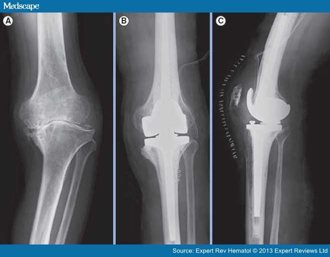 Special Features of Total Knee Replacement in Hemophilia - Page 9