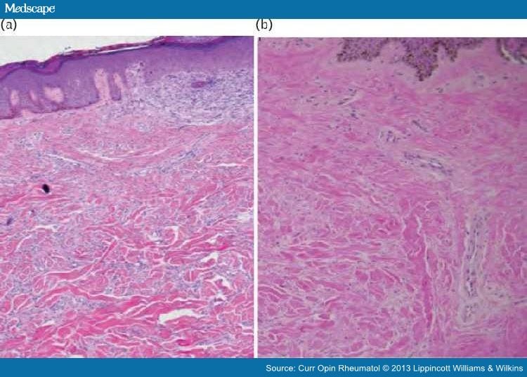 The Differential Diagnosis of Systemic Sclerosis